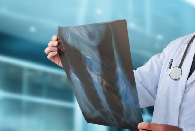 Lung Nodules: Causes, Symptoms, and More - Hello Doctor