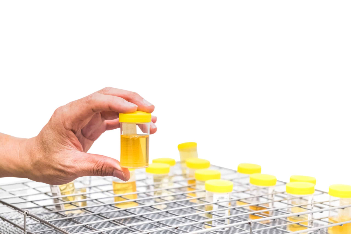 How To Read Urinalysis Results for UTI: What You Should Know