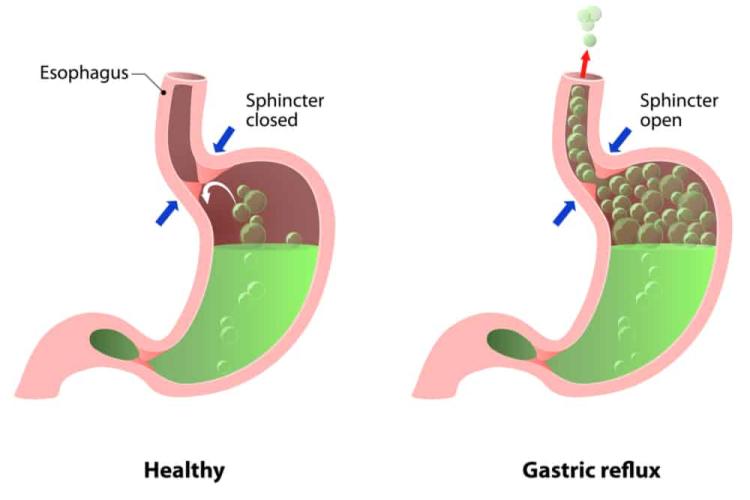 Lower Esophageal Sphincter Dysfunction: Everything You Need To Know