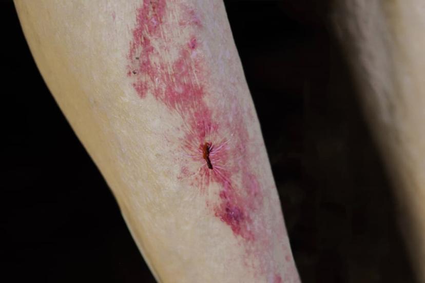 Cutaneous Vasculitis: What Are These Red and Purple Rashes?