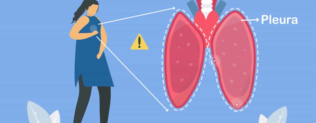 Pleurisy: What To Know About Its Causes, Symptoms, Treatment