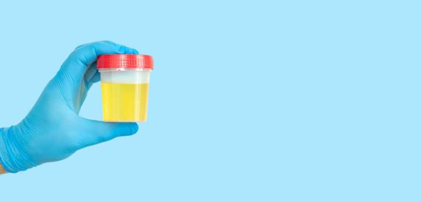 Urinalysis (Urine Test): Why and How is it Done?