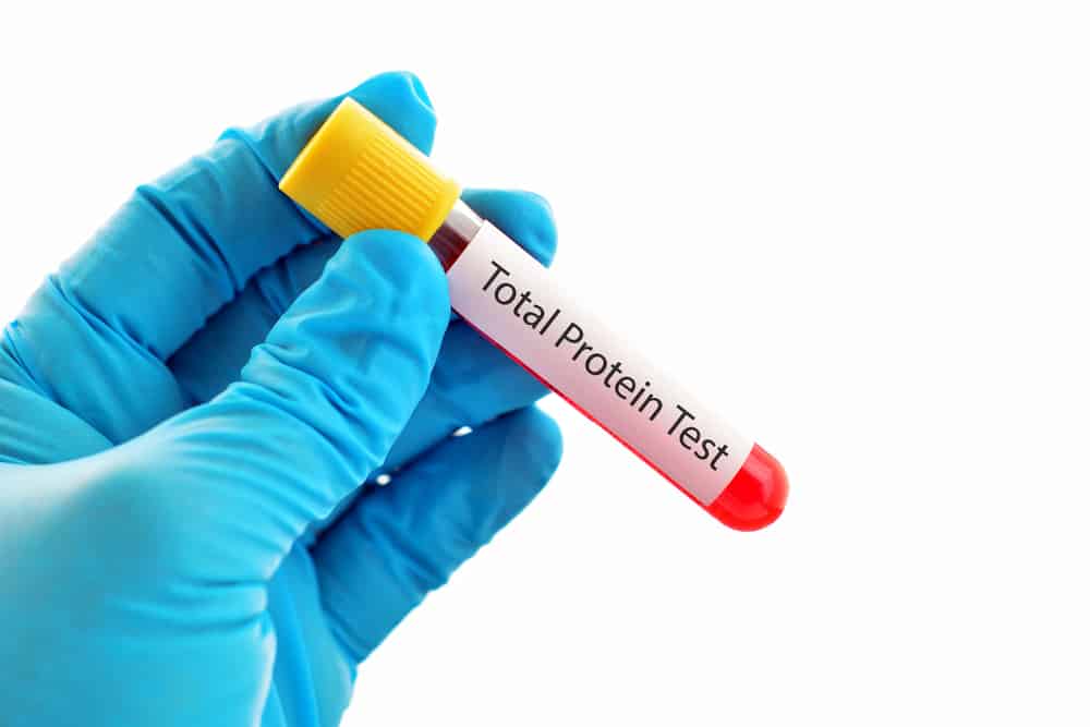 Total Protein Test: Why and How Is It Done? When Do I Need One?
