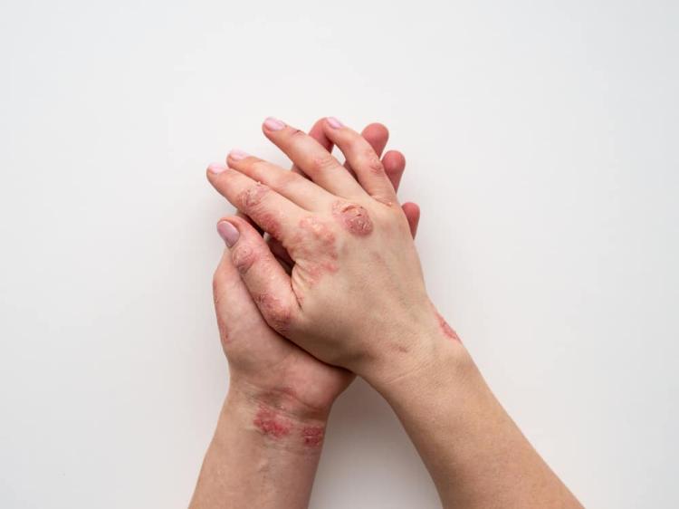 Is Psoriasis Contagious? Here's What You Need To Know