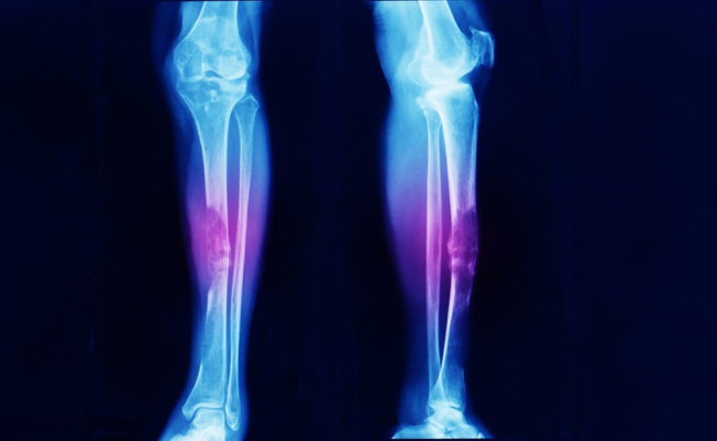Bone Cancer: Symptoms, Causes, and Treatment Of This Cancer