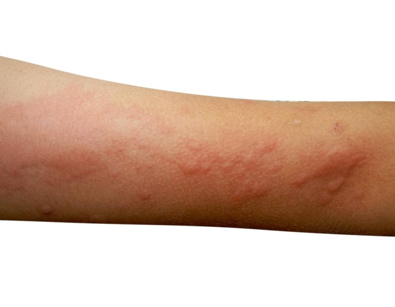 Irritant Contact Dermatitis: Common Household Chemicals That Trigger It