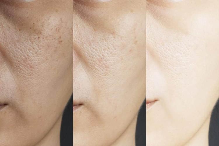 Minimize Pores Naturally: 4 Natural Ingredients To Try