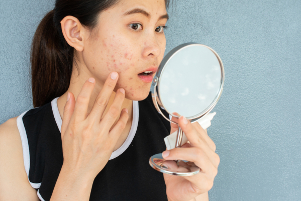 What Does It Mean to Have Cheek Acne? How Can You Treat It?