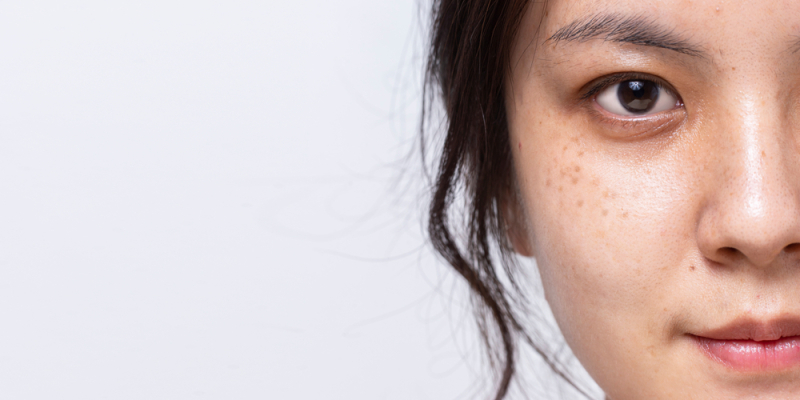 Are Freckles Symptoms of a Disease? Learn More About It Here