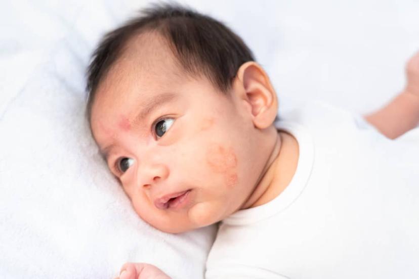 What Are Salmon Patches? Are These Birthmarks Permanent?