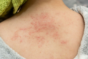 Bungang Araw Remedy: Mga Sanhi At Paggamot Sa Prickly Heat
