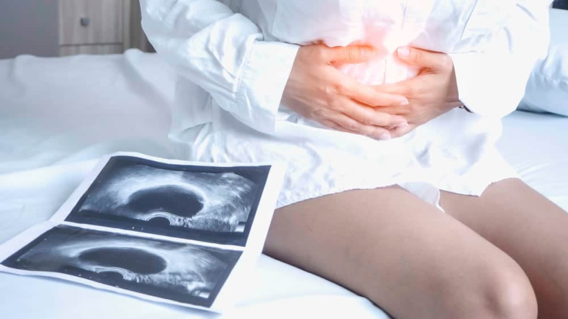 Sanhi at Sintomas ng PCOS (Polycystic Ovary Syndrome): Alamin dito