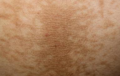 A Closer Look at Different Diabetic Rash Types and Other Skin Conditions