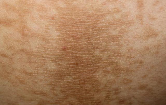A Closer Look at Different Diabetic Rash Types and Other Skin Conditions