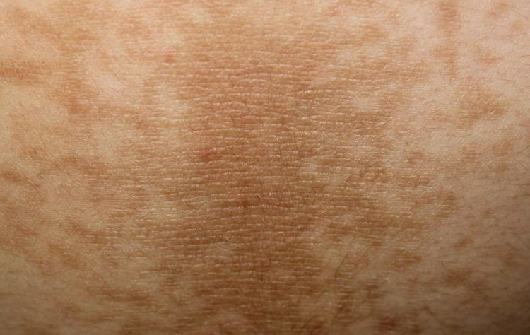 A Closer Look at Different Diabetic Rash Types and Other Skin Conditions