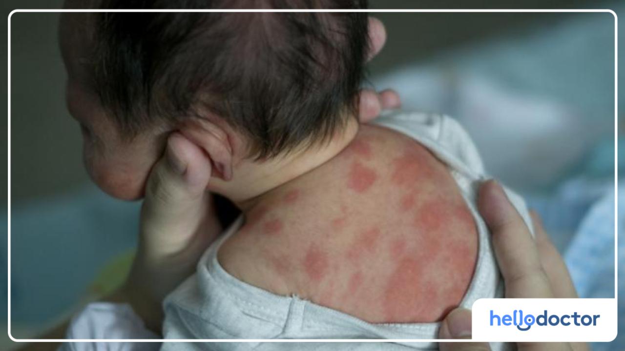 Rashes Sa Katawan Ng Bata: Ano Ang Mabisang Gamot?