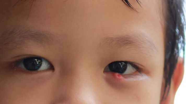 Kuliti sa Bata: Alamin ang Sanhi, Sintomas, at Gamot para Dito