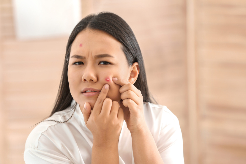 Pimples on Face? Do’s and Don’ts of Acne Treatment