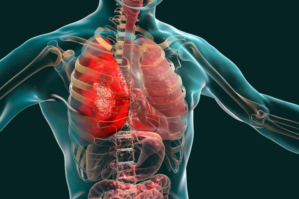 Ano ang Pulmonya? Sanhi, Sintomas, Paggamot, at Pag-iwas Dito