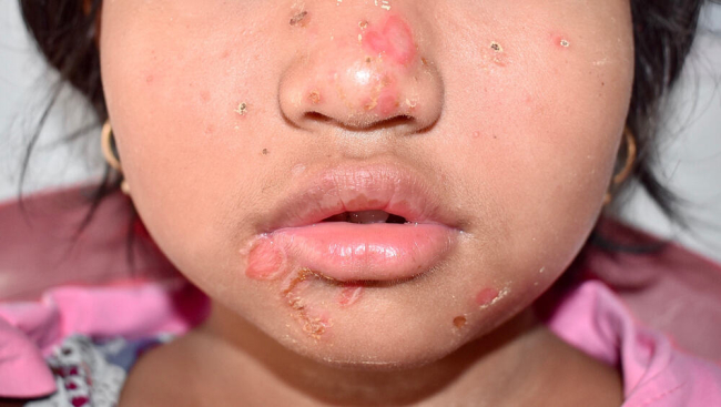 Mamaso o Impetigo: Lahat ng Dapat Mong Malaman