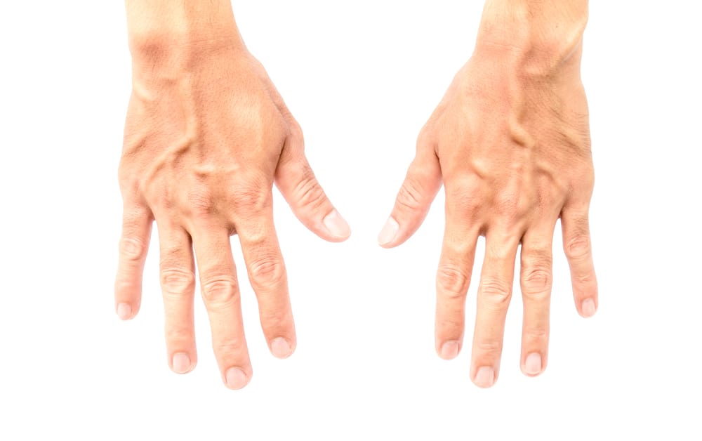 Pasma Sa Ugat, Paano At Bakit Nagkakaroon Nito? Alamin Dito