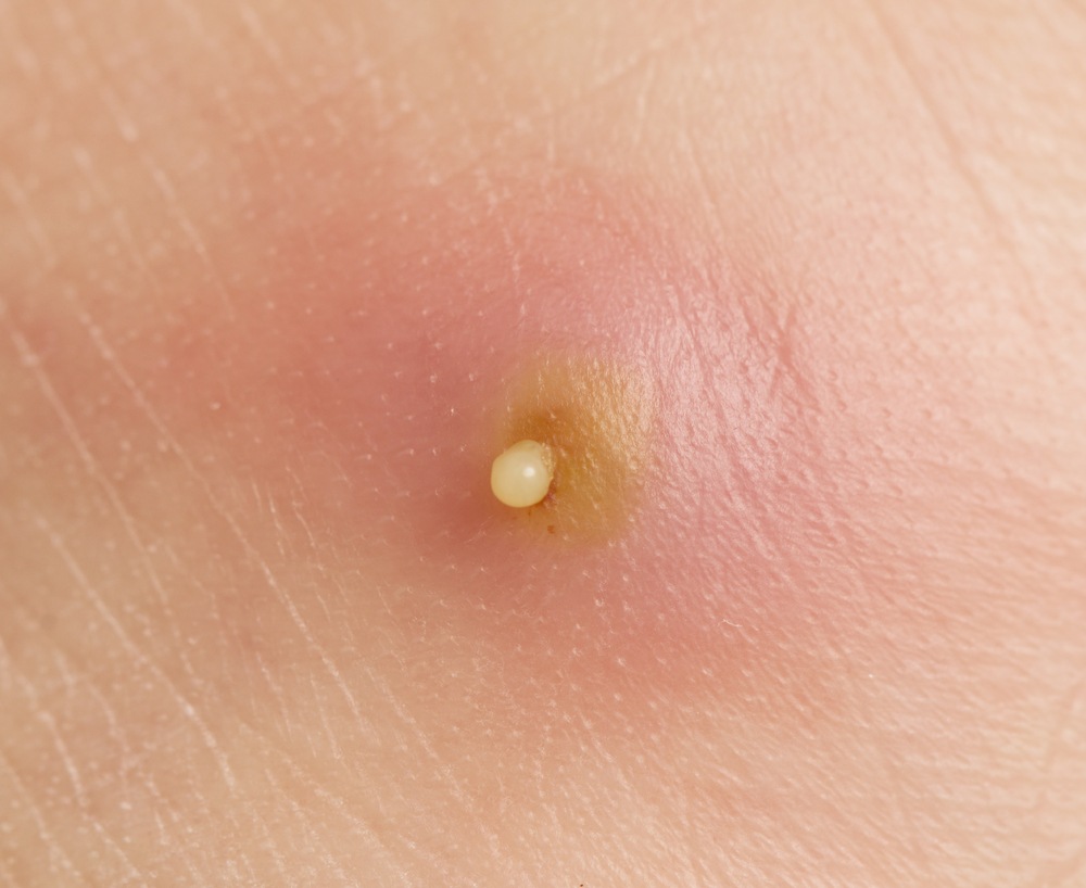 Halamang Gamot Sa Pigsa: Ano Ba Ang Pinakamabisa?