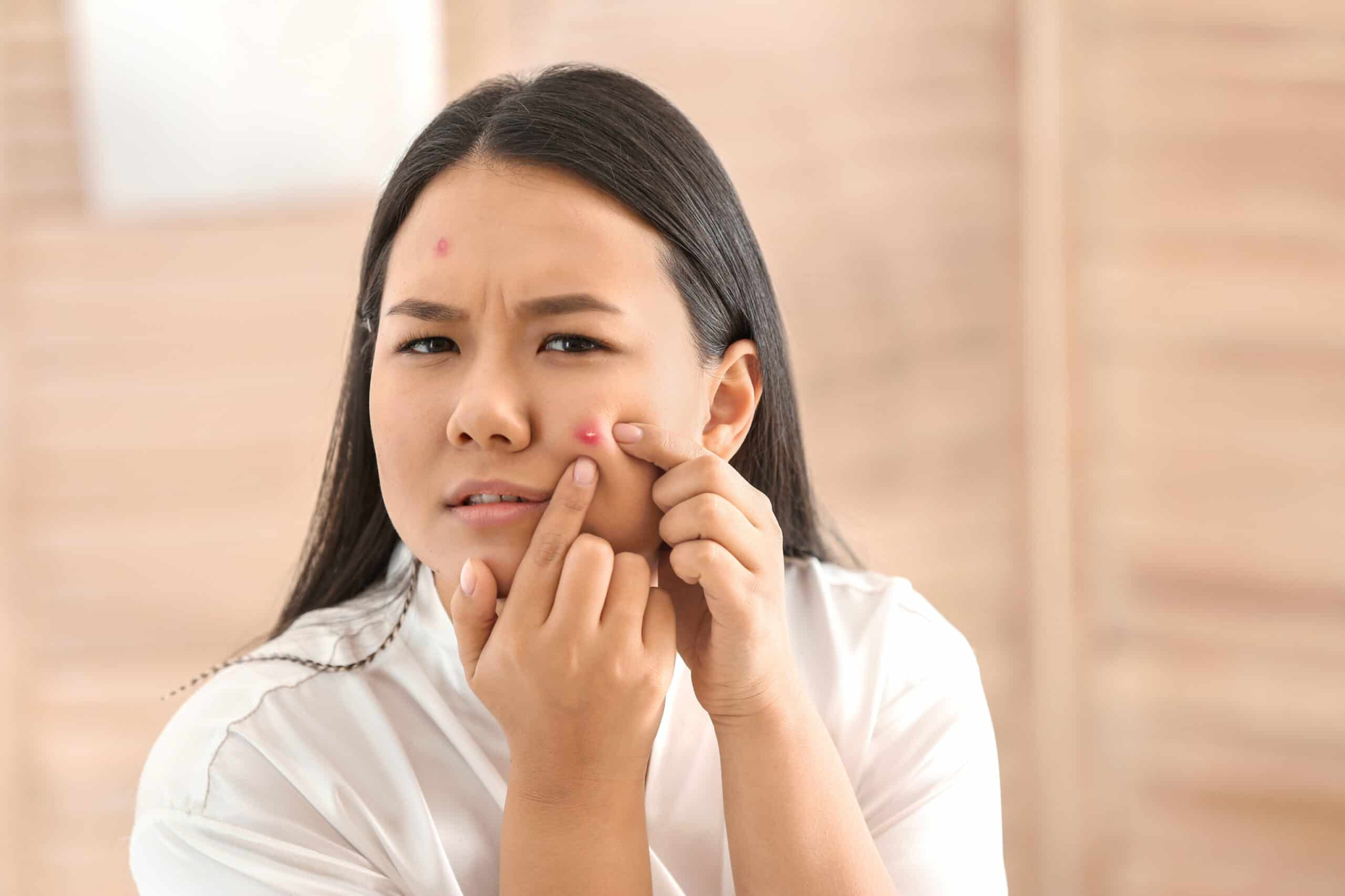 How To Remove Dark Spots Caused By Pimples: Try These Tips
