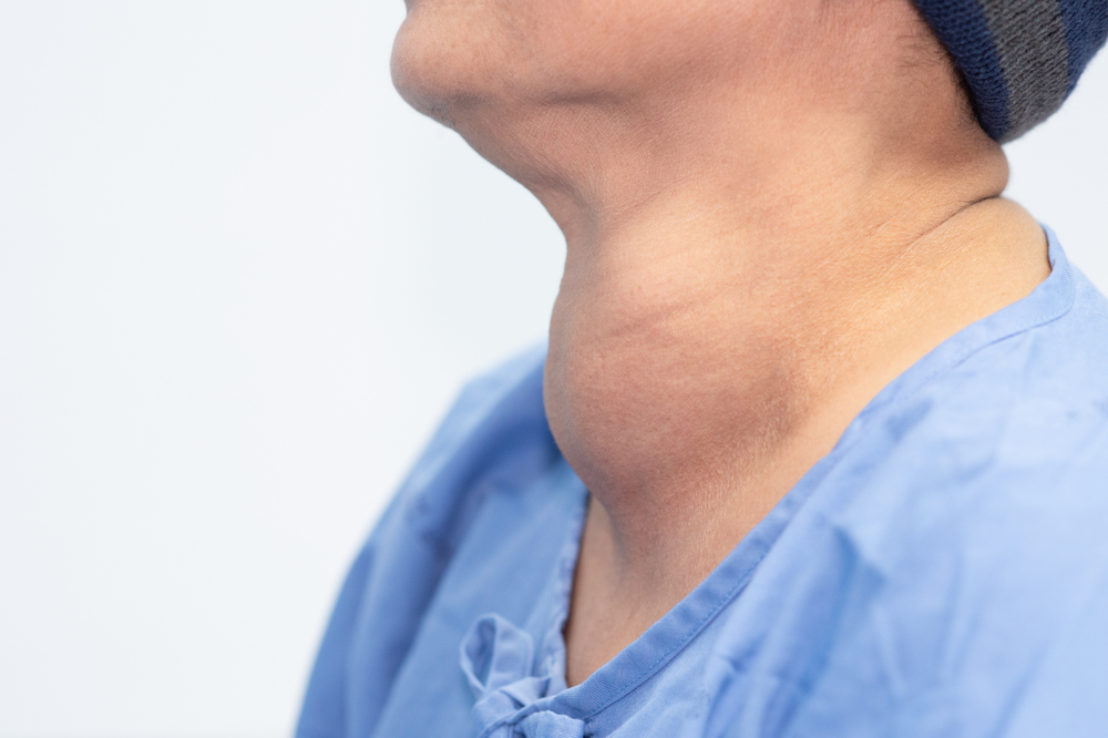 Ano Ang Goiter? Sanhi, Sintomas, Gamot, At Pag-Iwas