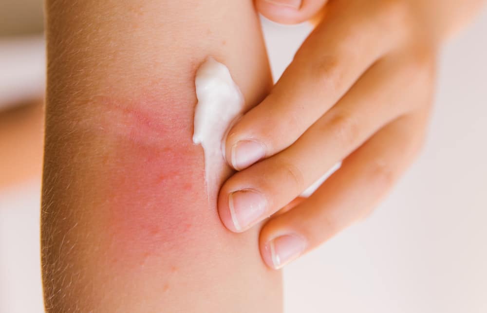Gamot Sa Allergy Sa Balat, Anu-Ano Nga Ba Ito? Alamin Dito