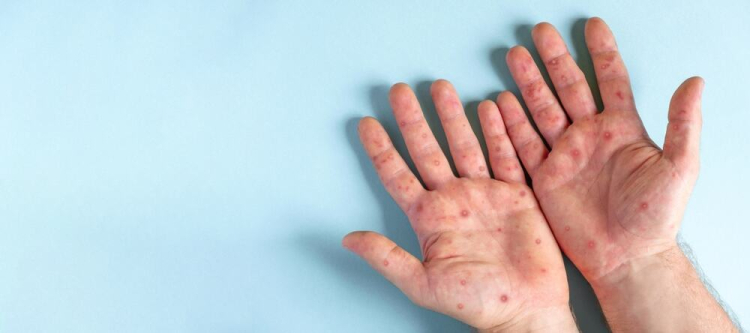 Rashes Lang Ba, o Monkeypox Na? Paano Malalaman Kung Monkeypox