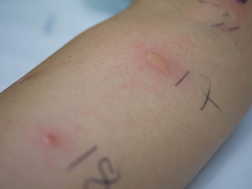 Mga Allergy - Hello Doctor