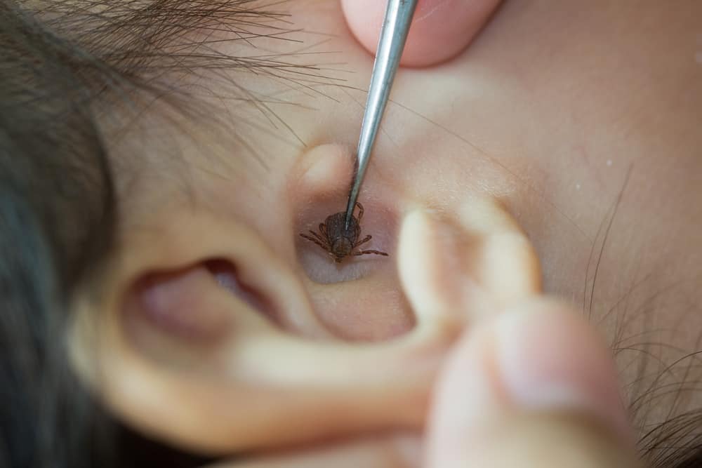 Insekto sa Tenga: Paano Ito Tanggalin? Alamin Dito!