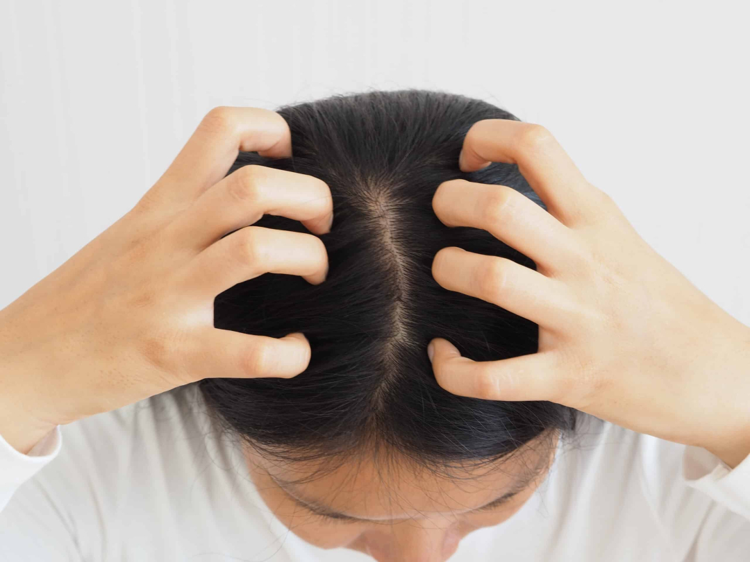 Tinea Capitis Or Ringworm Of The Scalp: How Do You Treat It?