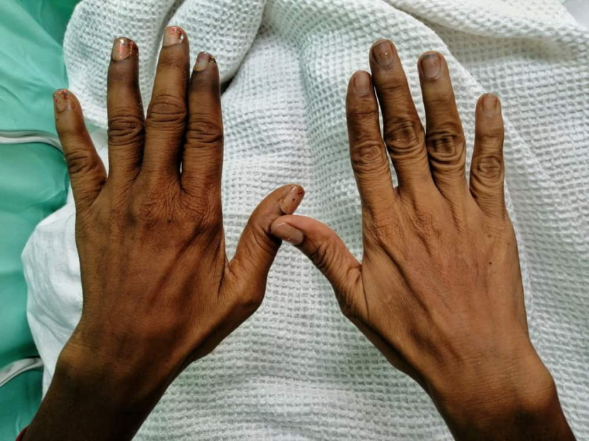 Gamot Sa Buerger Disease: Mga Dapat Malaman Ng Mga Naninigarilyo
