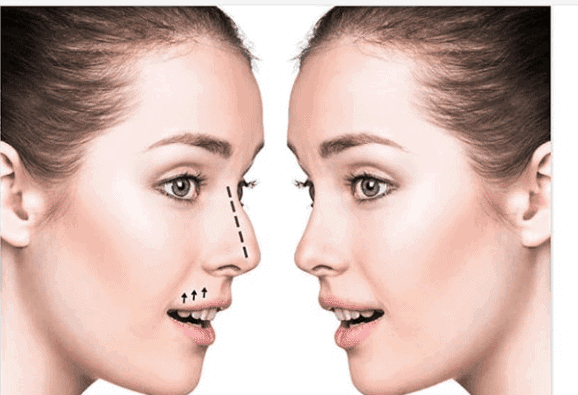 Paano Ginagawa ang Rhinoplasty At Para Saan Ito?