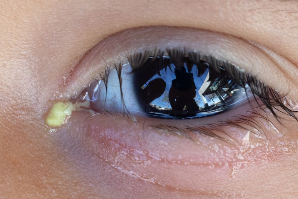 Mga Dapat Malaman Tungkol Sa Sanhi Ng Blepharitis At Paggamot Dito