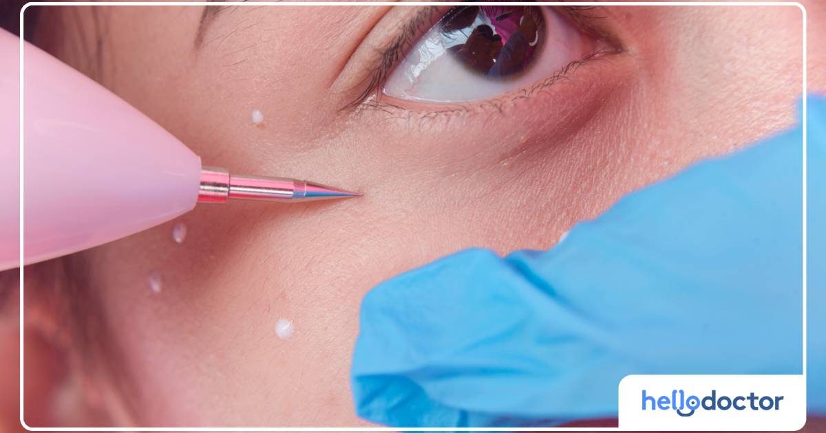 Goodbye Warts! Narito Ang 5 Pantanggal Ng Iyong Kulugo!