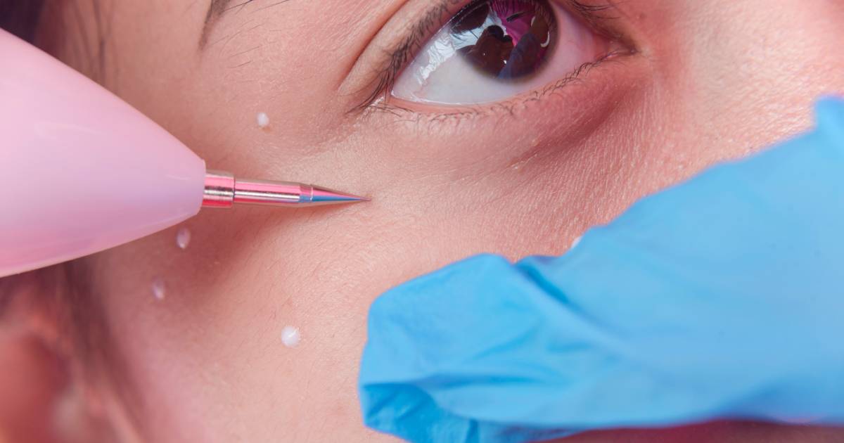 Goodbye Warts! Narito Ang 5 Pantanggal Ng Iyong Kulugo!