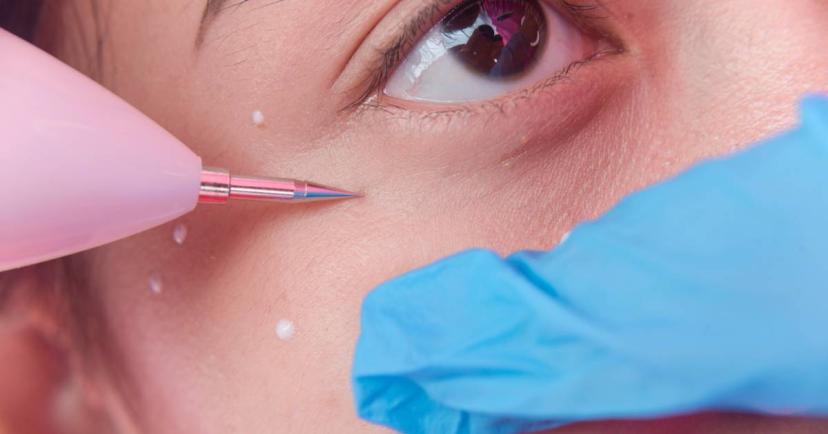 Goodbye Warts! Narito Ang 5 Pantanggal Ng Iyong Kulugo!